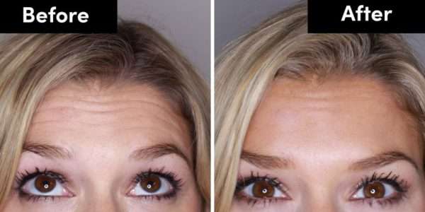 Botox - Dermatology of Seattle & Bellevue