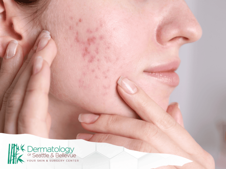 Effective Non Surgical Methods for Treating Severe Acne Scarring ...