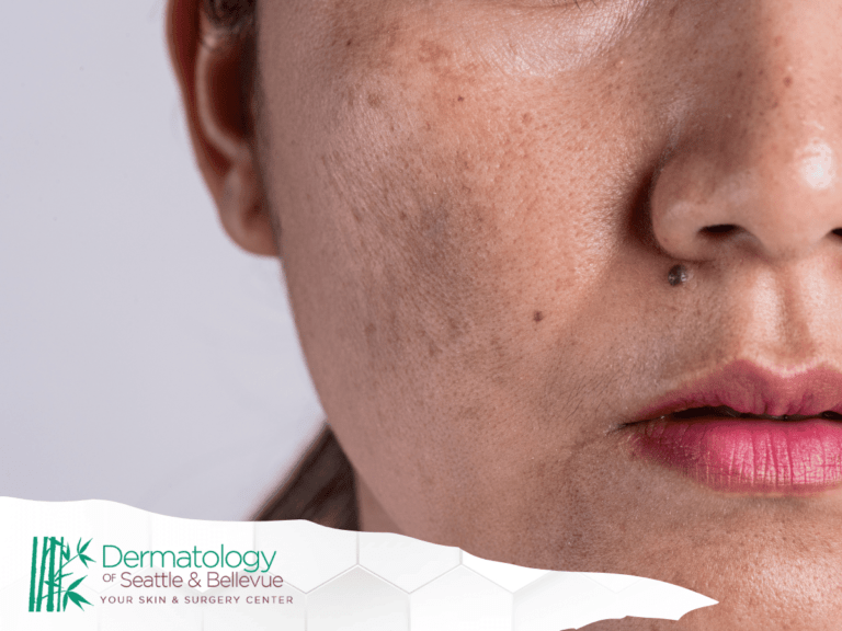 Can a Menopausal Woman Get Melasma? - Dermatology of Seattle & Bellevue