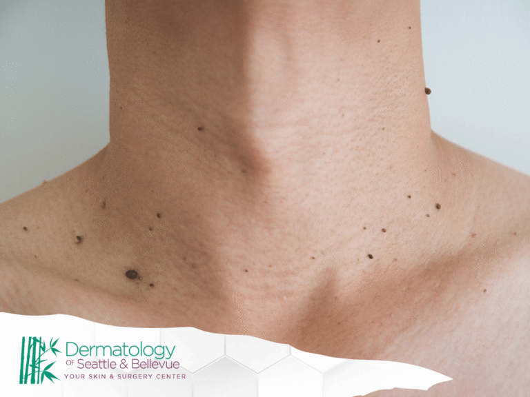 Skin Tags or Something Else? When to Get a Growth Checked - Dermatology ...