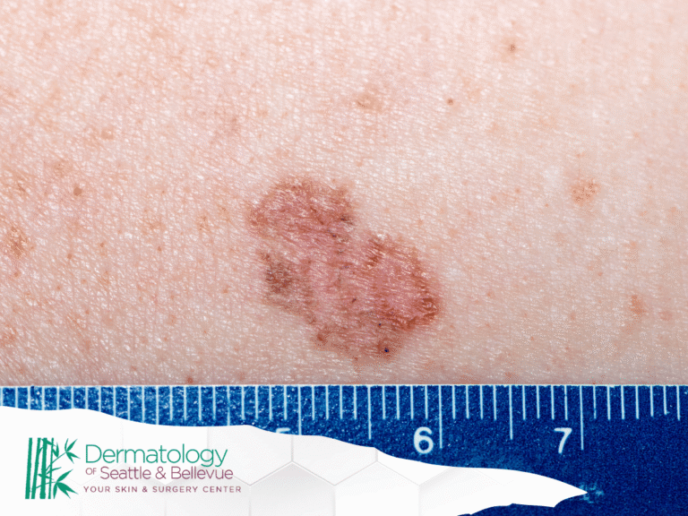 How Long Can Basal Cell Carcinoma Go Untreated?