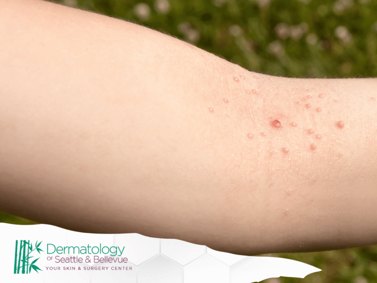 Molluscum Contagiosum: What Parents Should Know About This Common Kids ...