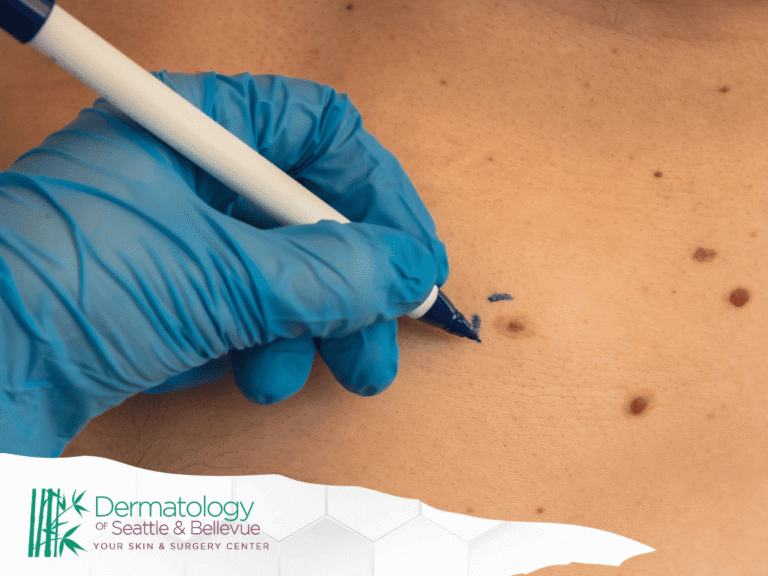 How to Tell If a Skin Tag Might Be a Rare Skin Cancer - Dermatology of ...