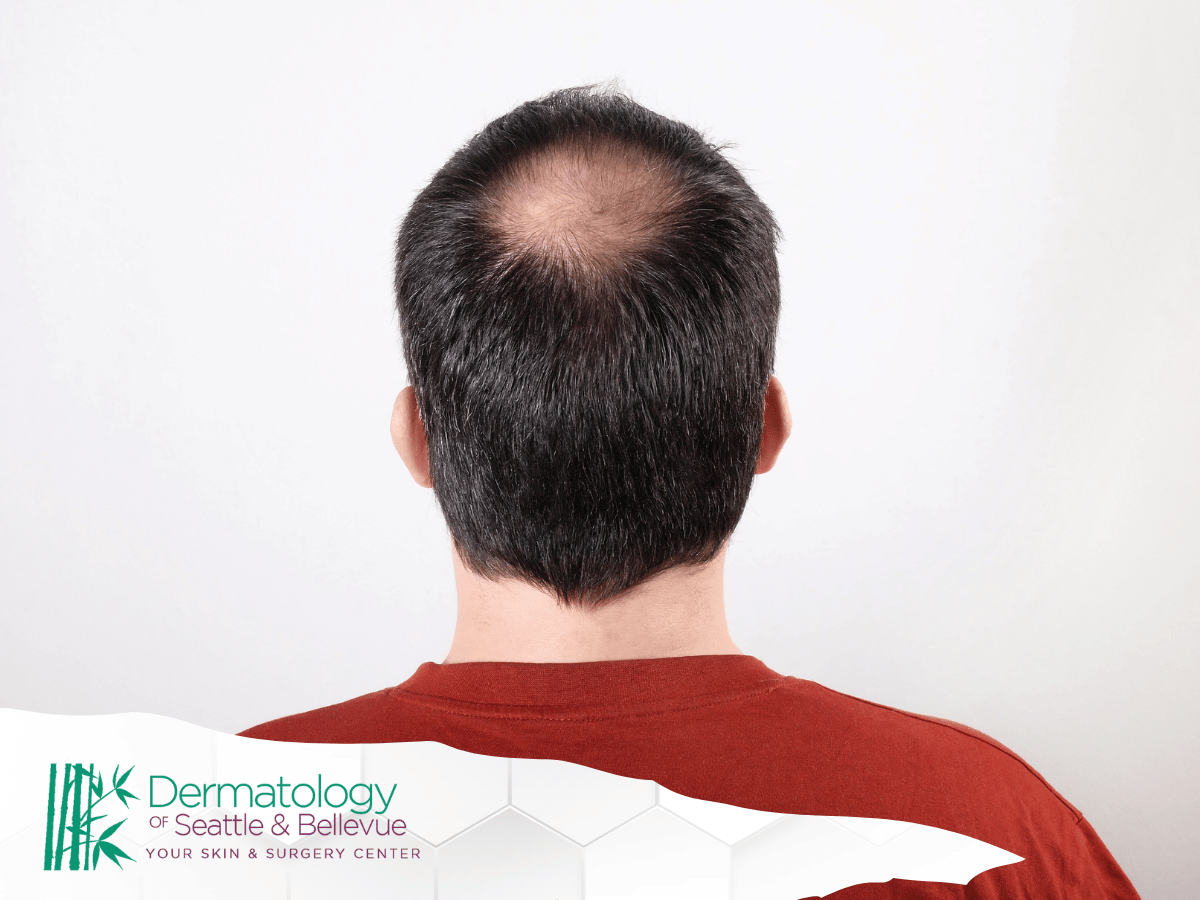 Does High Blood Pressure Cause Hair Loss or Is It the Medication ...